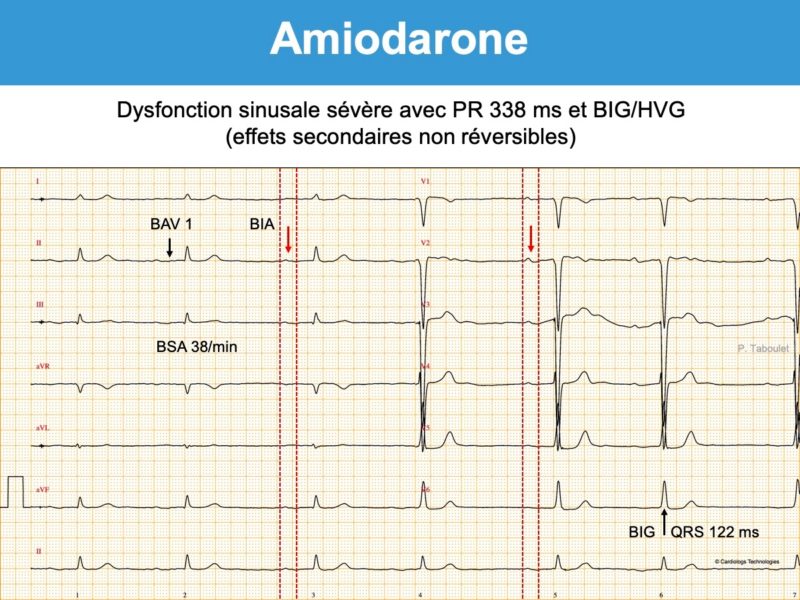 Amiodarone : e-cardiogram