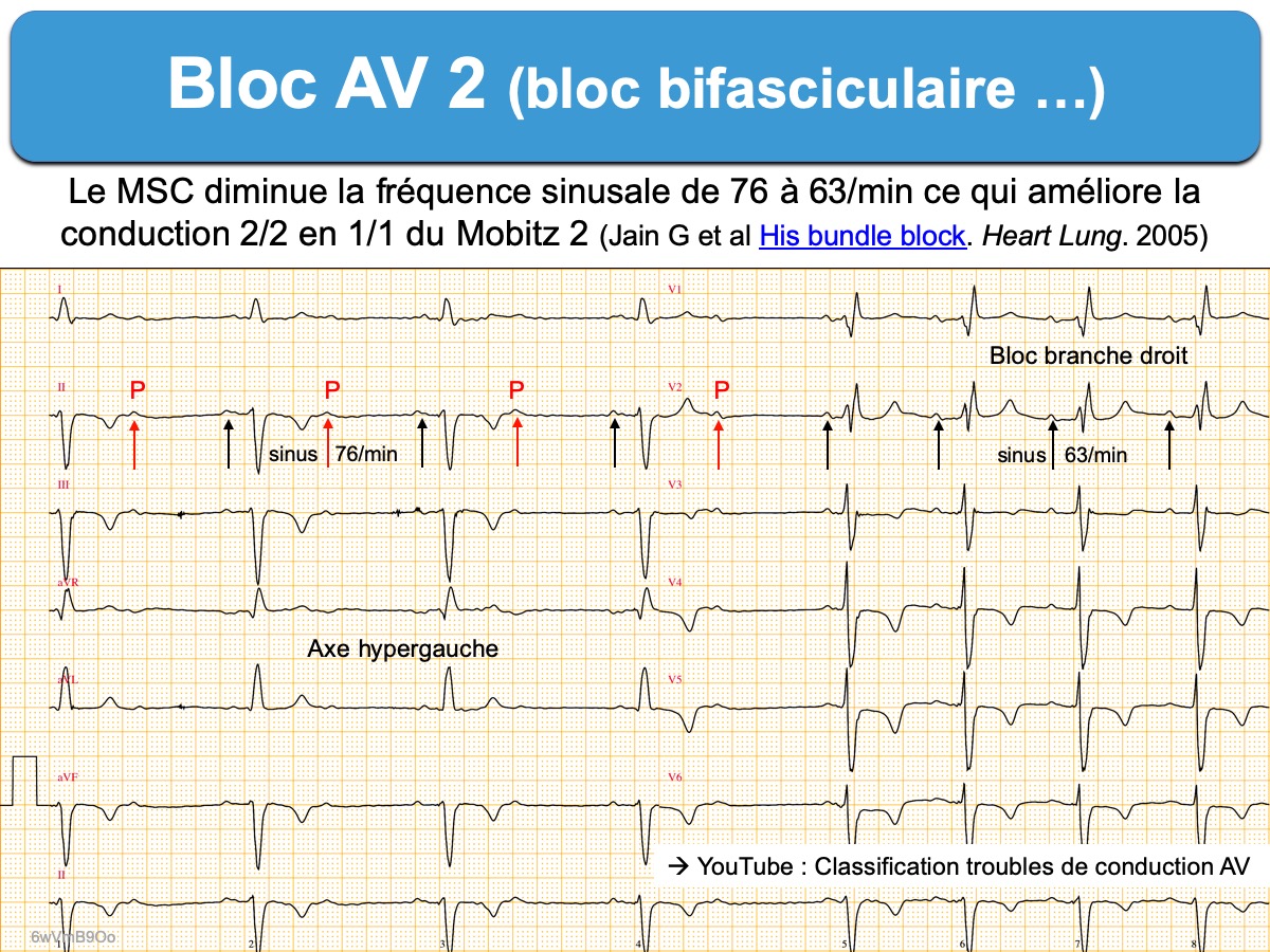 Bloc AV 2e degré. Bloc 2/1 : e-cardiogram