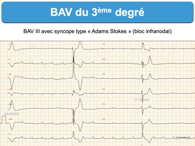 Bloc AV 3ème degré : e-cardiogram