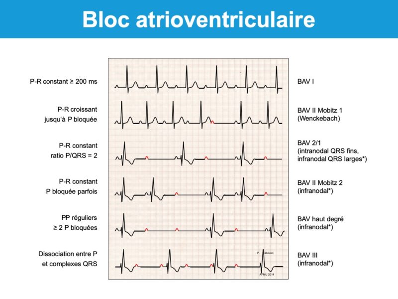 Bloc atrioventriculaire : e-cardiogram