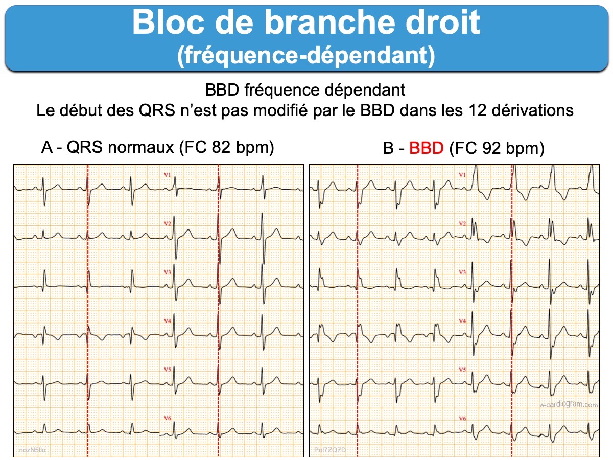 Bloc de branche 2. droit complet : e-cardiogram