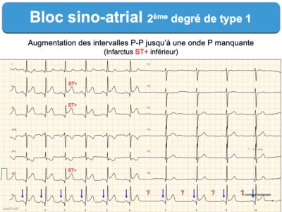 Bloc sino-atrial (BSA) : e-cardiogram