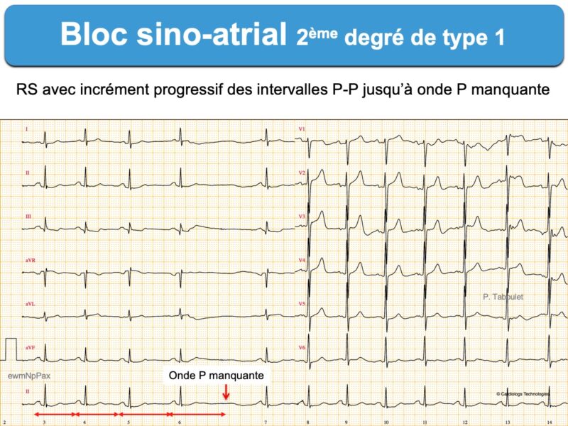 Bloc sino-atrial (BSA) : e-cardiogram