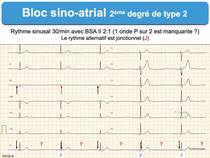 Bloc sino-atrial (BSA) : e-cardiogram