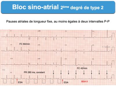 Bloc sino-atrial (BSA) : e-cardiogram