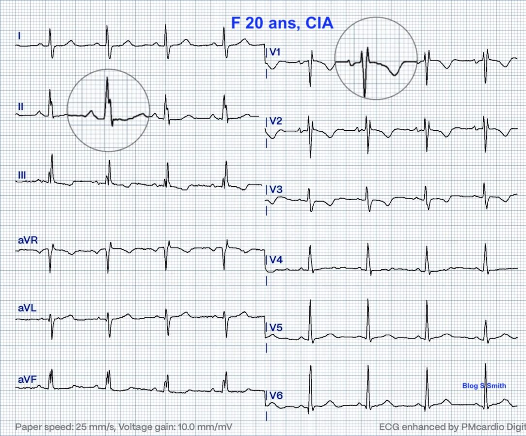 Cardiomyopathie VD arythmogène : e-cardiogram