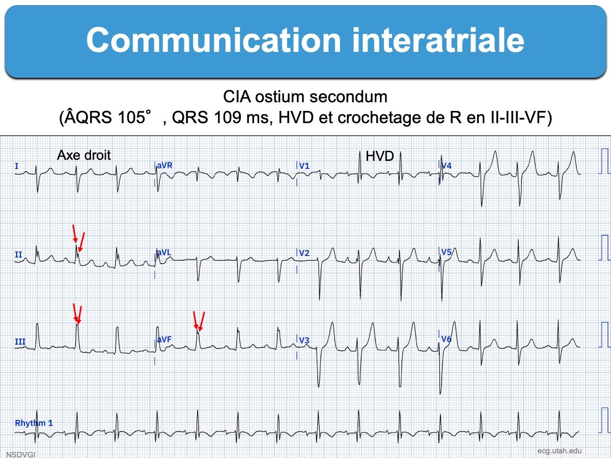 Communication interatriale : e-cardiogram