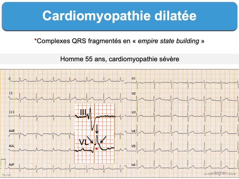 Complexes QRS fragmentés 1. fins : e-cardiogram