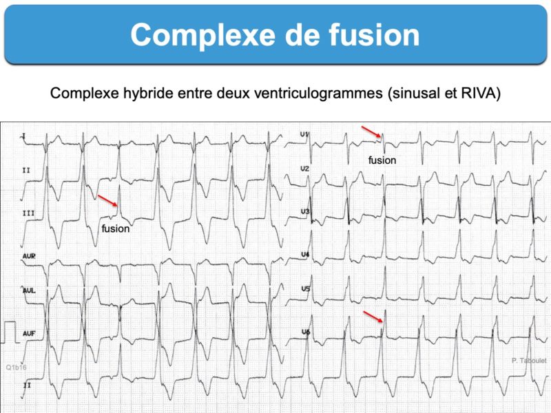 Complexe de fusion : e-cardiogram