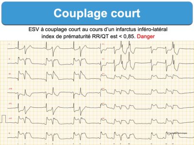Couplage : e-cardiogram