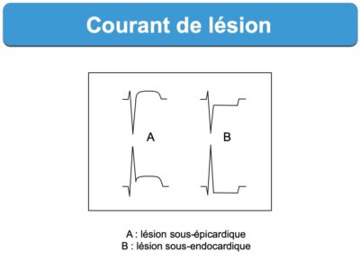 Courant de lésion : e-cardiogram