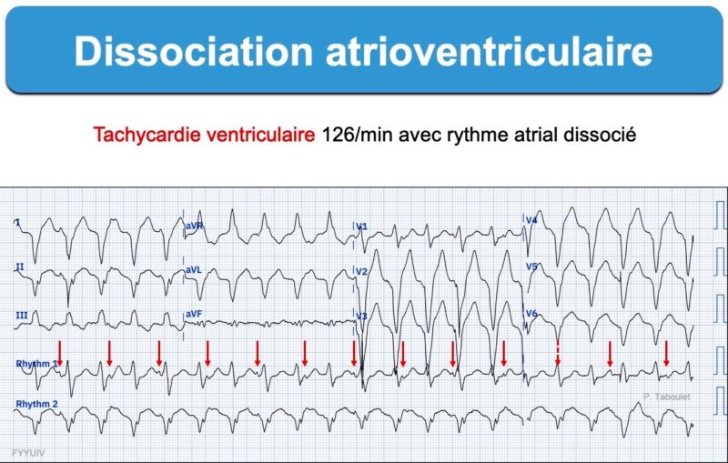 Dissociation atrioventriculaire : e-cardiogram