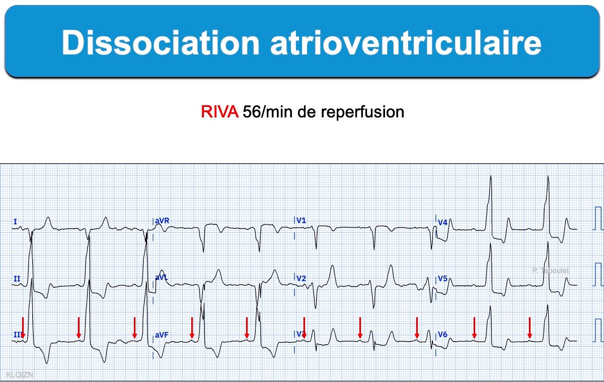 Dissociation Atrioventriculaire Cardiaque – XIJMH