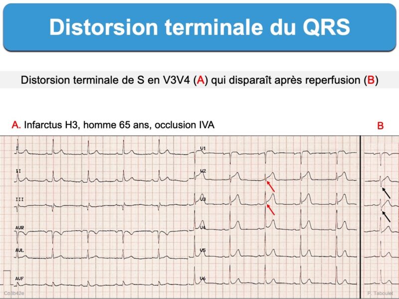 Distorsion terminale du QRS : e-cardiogram