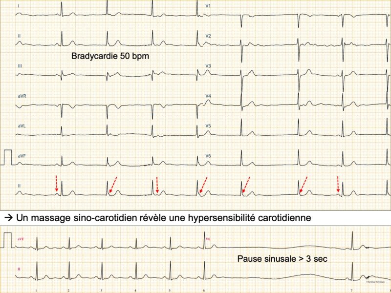 Dysfonction sinusale : e-cardiogram