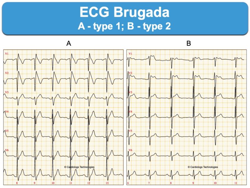 Syndrome de Brugada : e-cardiogram