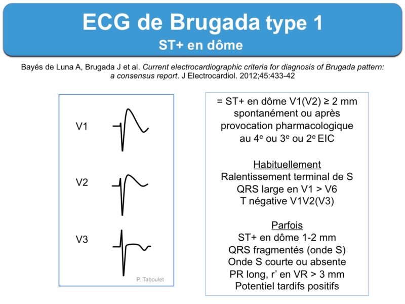 ECG Brugada : e-cardiogram