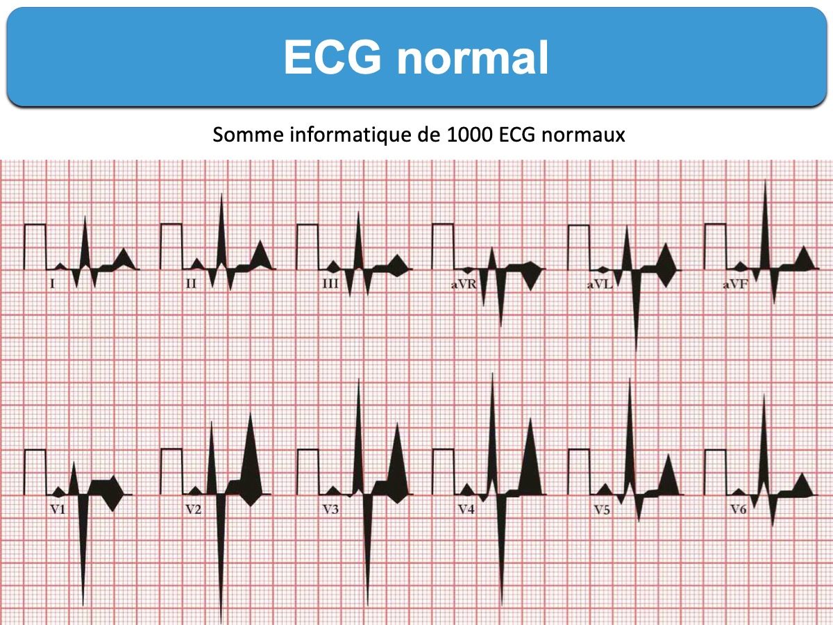 Progression harmonieuse des ondes R : e-cardiogram