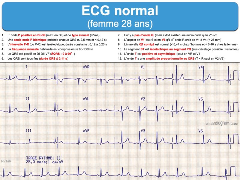 ECG : normal : e-cardiogram