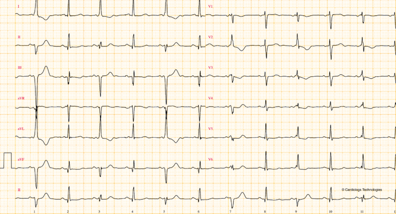 Parasystolie : e-cardiogram