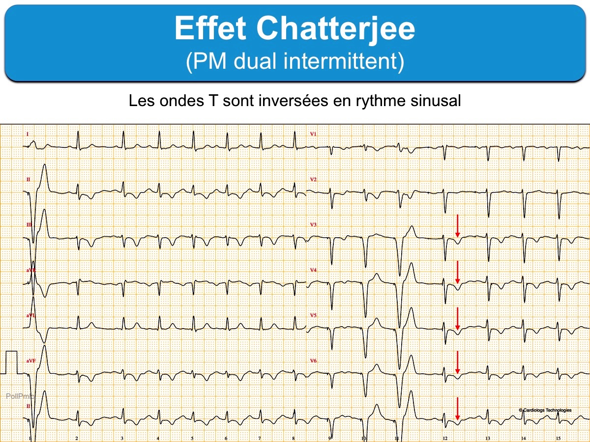 Effet Chatterjee : e-cardiogram