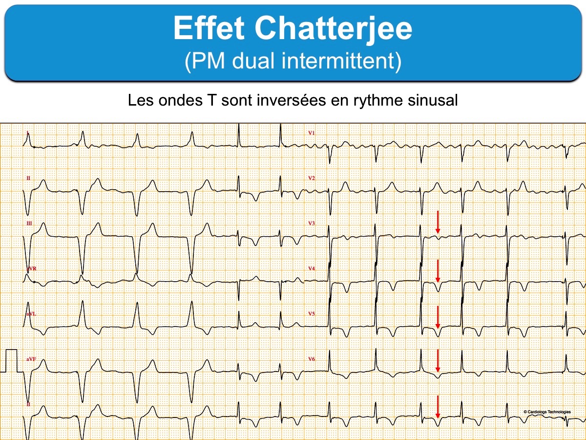Effet Chatterjee : e-cardiogram