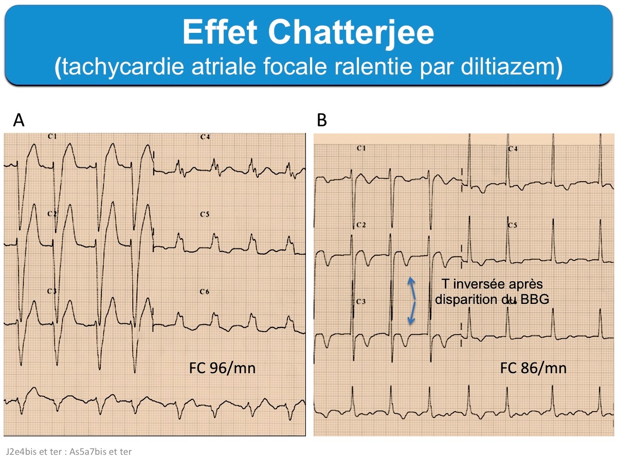Effet Chatterjee : e-cardiogram