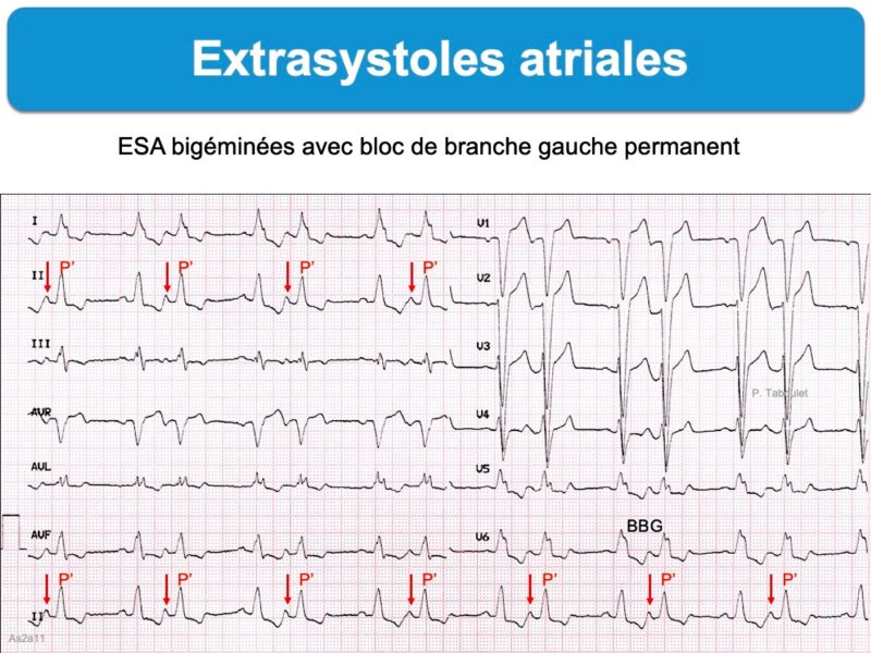 Extrasystole atriale : e-cardiogram