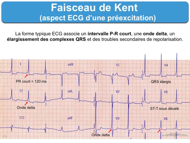 Faisceau de Kent : e-cardiogram
