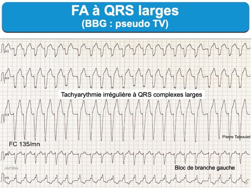 Ecg De Fa: Définition Fibrillation Atriale – WEMOVB