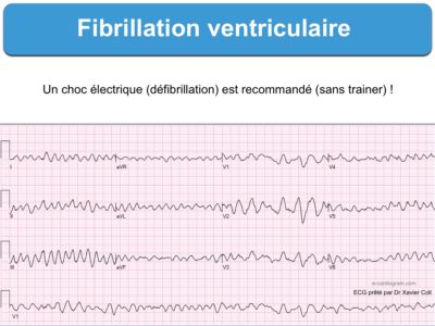 Fibrillation ventriculaire. FV : e-cardiogram