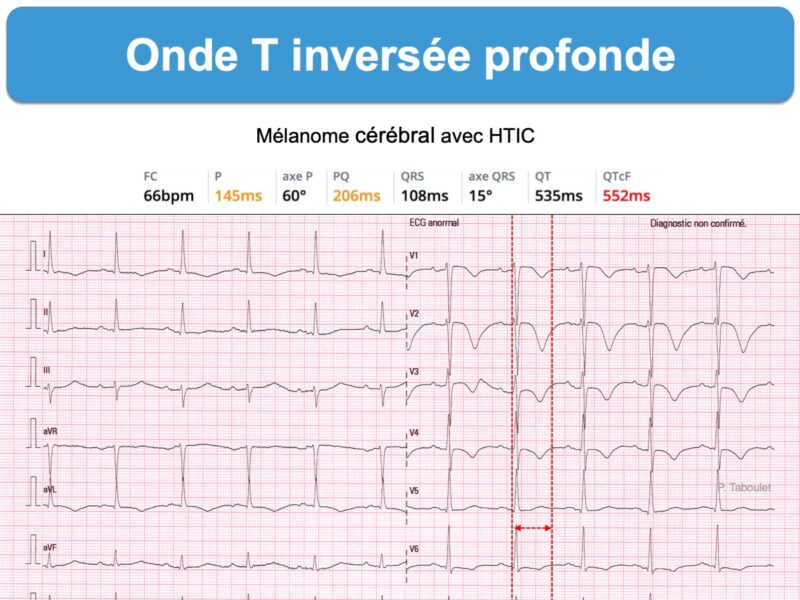 Onde T inversée : e-cardiogram