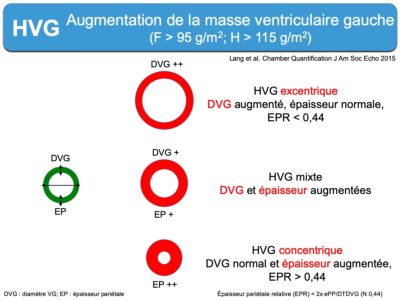Hypertrophie VG (HVG) 1. Diagnostic : e-cardiogram
