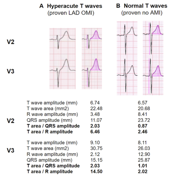 Onde T ample : e-cardiogram