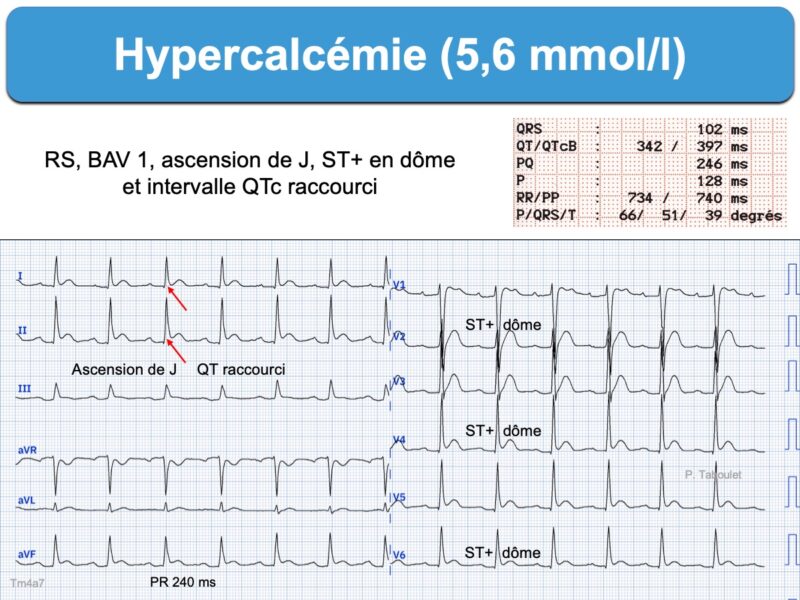 Hypercalcémie : e-cardiogram