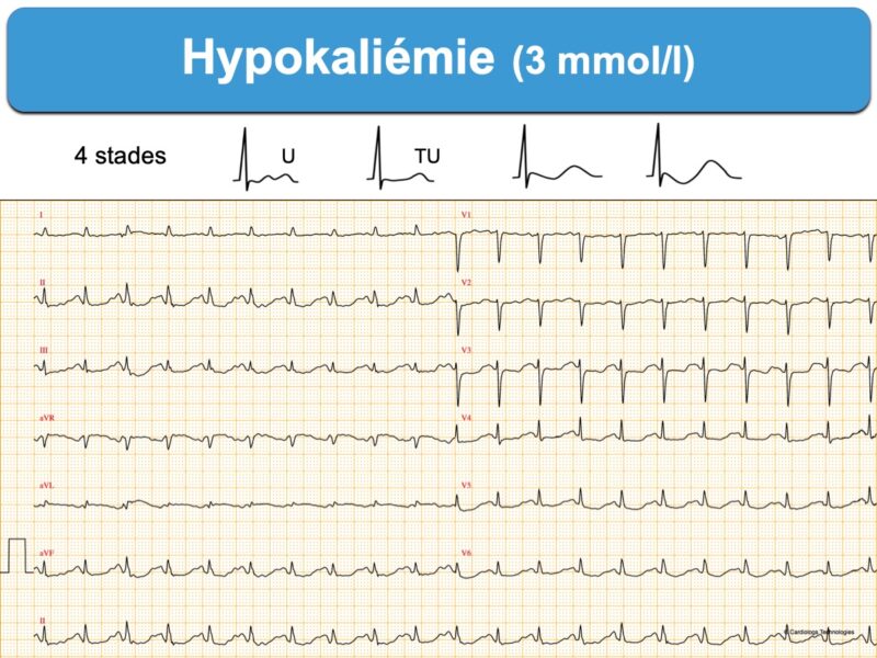 Hypokaliémie : e-cardiogram