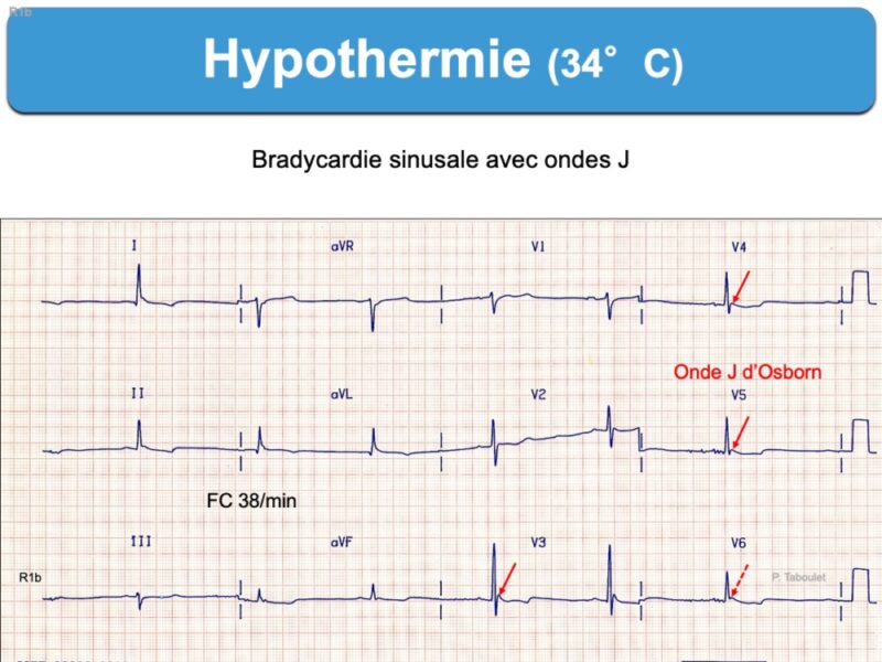 Bradycardie sinusale : e-cardiogram