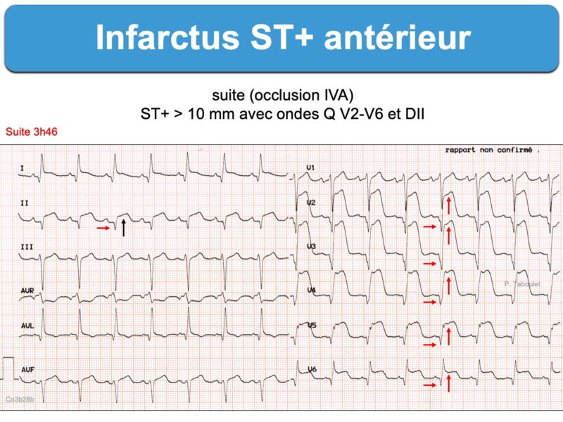 Sus-décalage de ST : ischémique ST+ : e-cardiogram