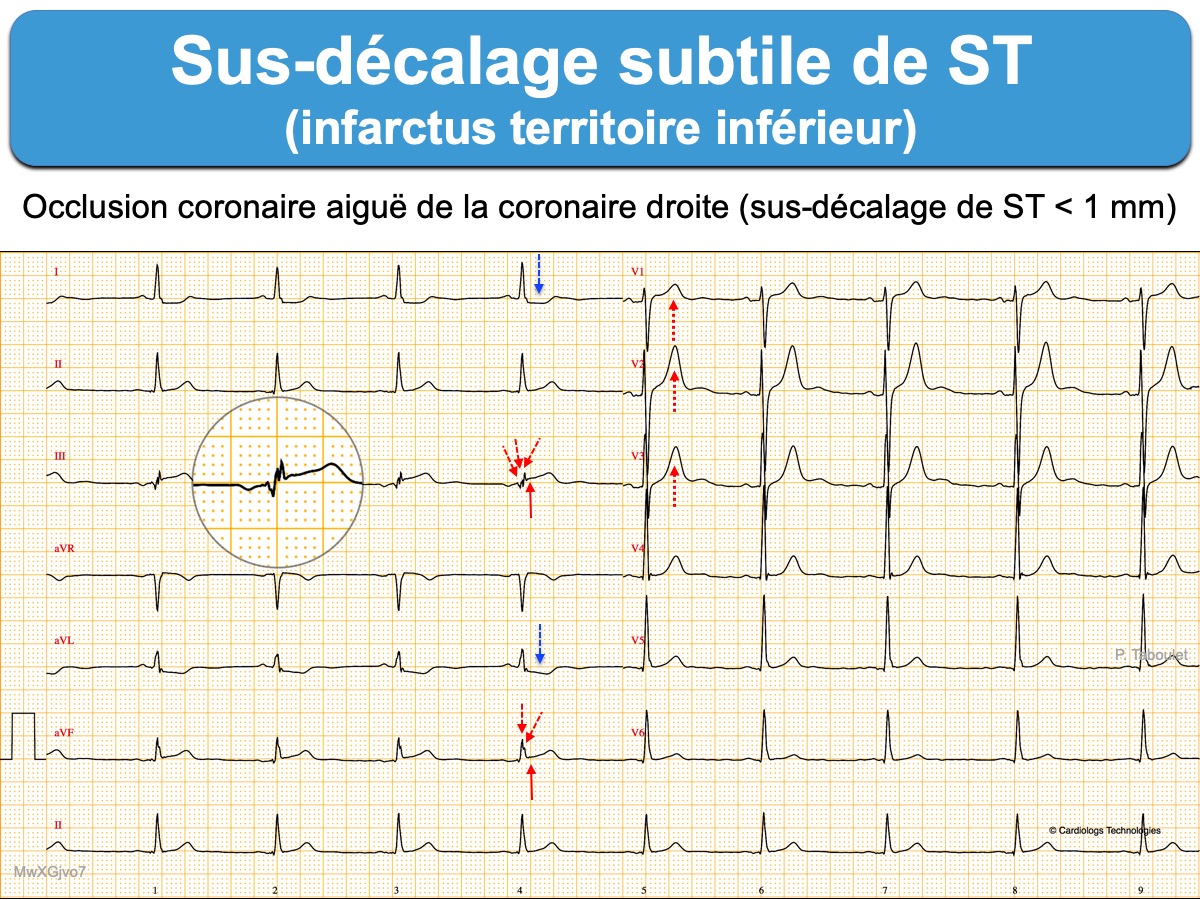 Sus-décalage de ST : ischémique (ST+) : e-cardiogram