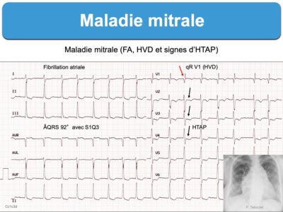 Valvulopathie mitrale : e-cardiogram