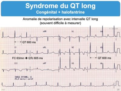Intervalle QT. 3. Long : e-cardiogram