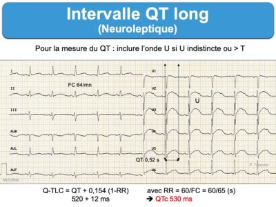 Intervalle QT. 3. Long : e-cardiogram