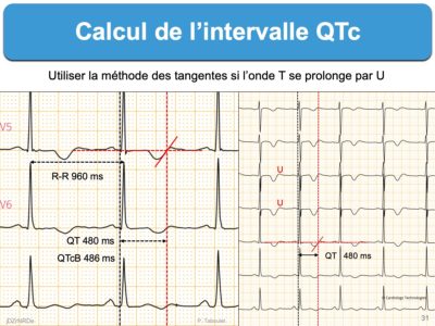 Intervalle QT. 2. QT corrigé (QTc) : e-cardiogram