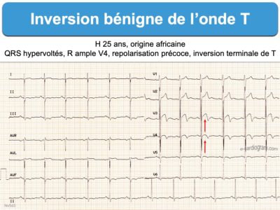 Inversion bénigne de l’onde T : e-cardiogram