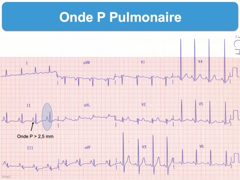 Onde P pulmonaire : e-cardiogram
