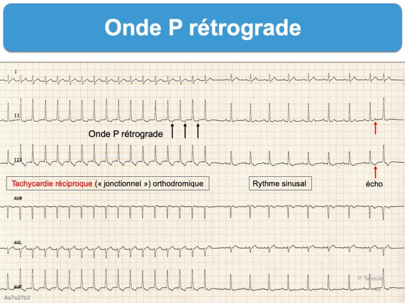 Onde P rétrograde : e-cardiogram