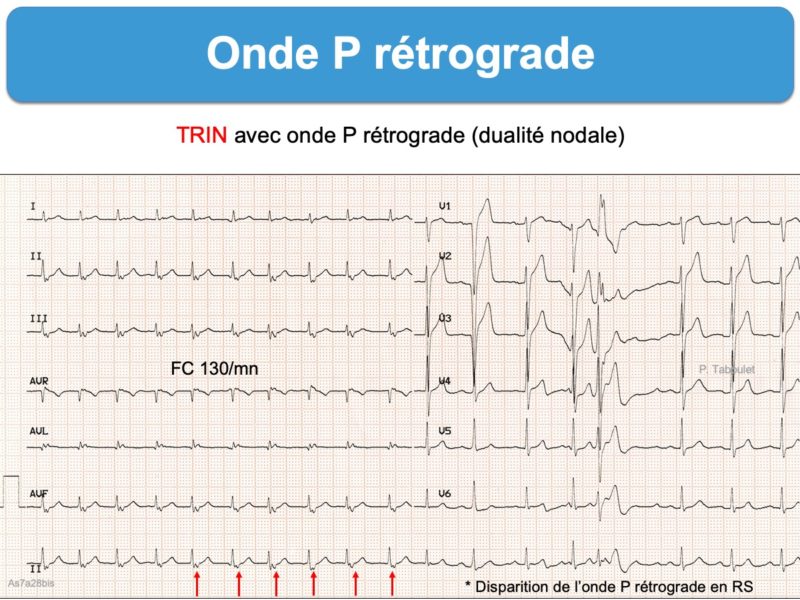 Onde P rétrograde : e-cardiogram