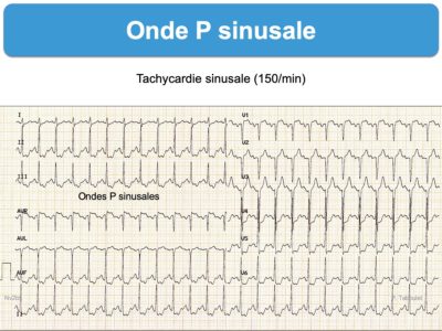 Onde P sinusale : e-cardiogram