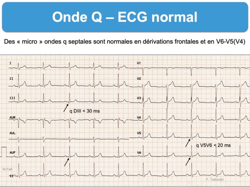 Onde Q : e-cardiogram