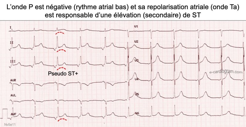 Onde T atriale (Ta) : e-cardiogram